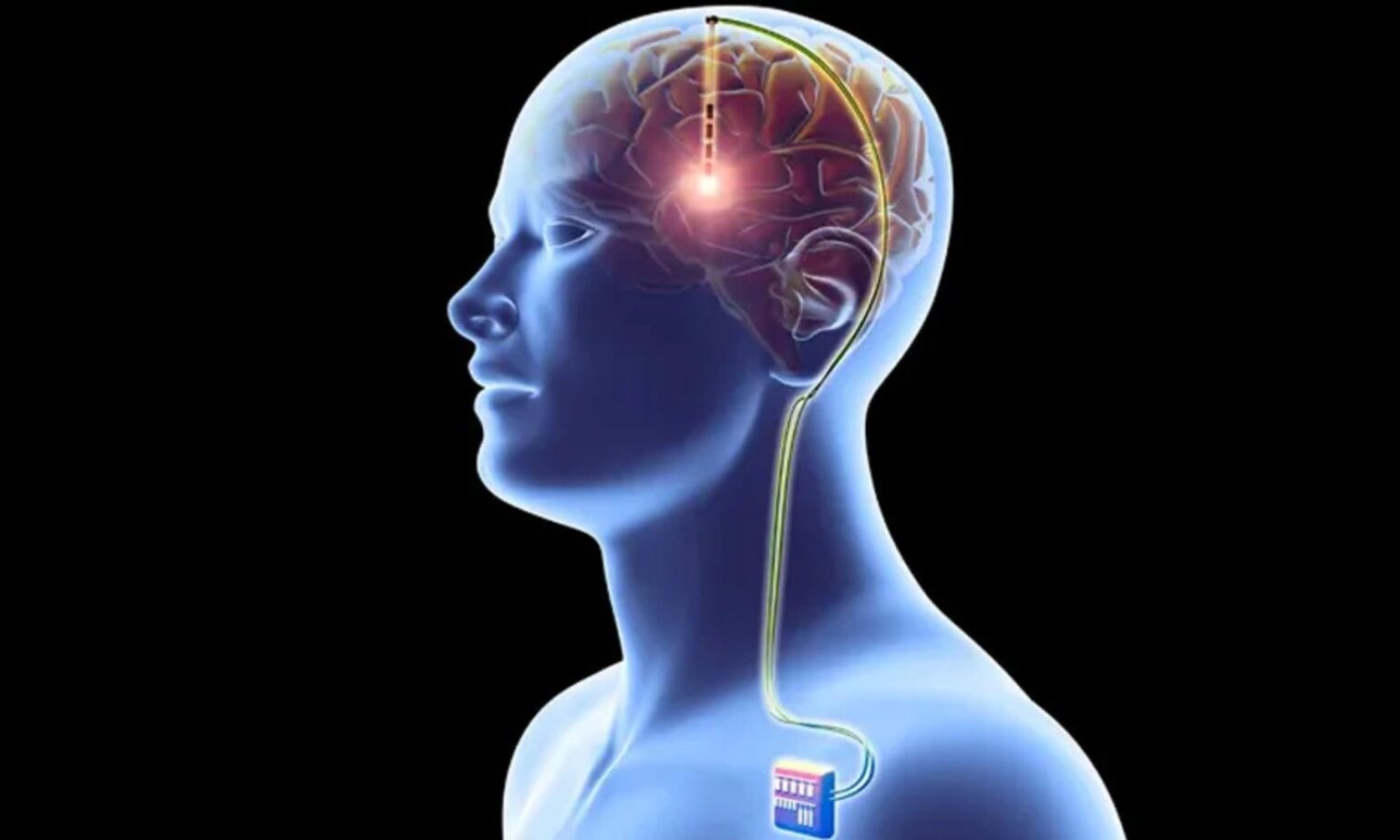 Deep Brain Stimulation (DBS) Surgery - Dr. Ninad Patil